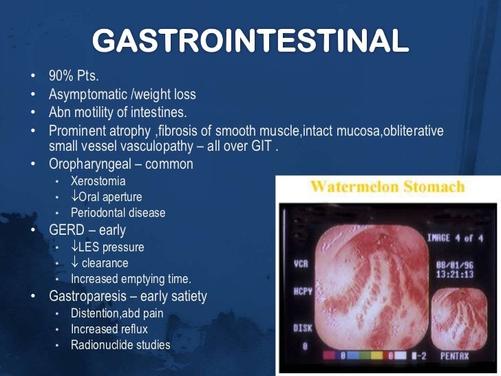 Systemic sclerosis..scleroderma