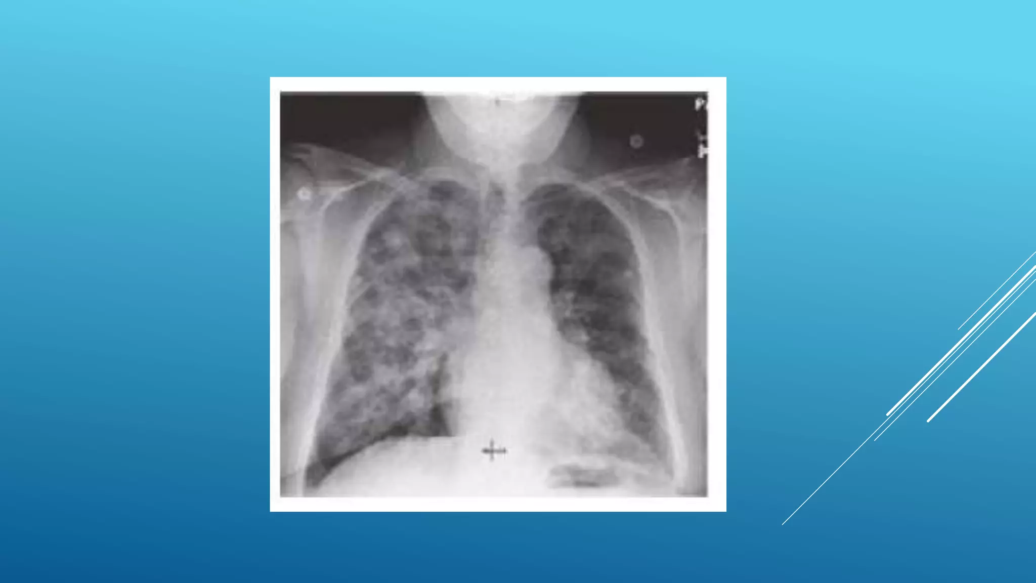 Systemic vasculitides - Wegener's Granulomatosis, Microscopic ...