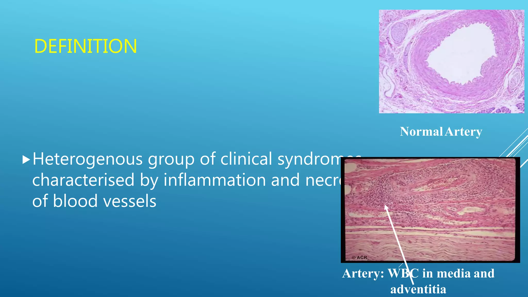 Systemic vasculitides - Wegener's Granulomatosis, Microscopic ...
