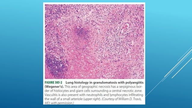 Systemic vasculitides - Wegener's Granulomatosis, Microscopic ...
