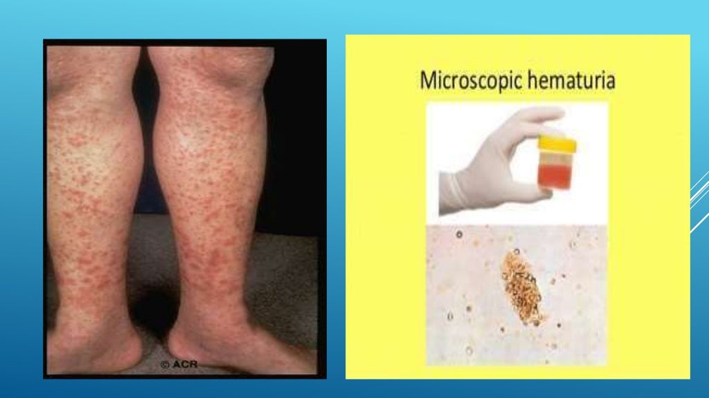 Systemic vasculitides - Wegener's Granulomatosis, Microscopic Polyang…