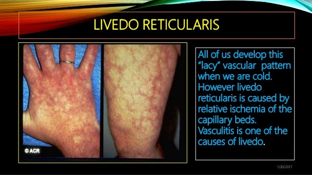 Systemic vasculitis 2016 shj