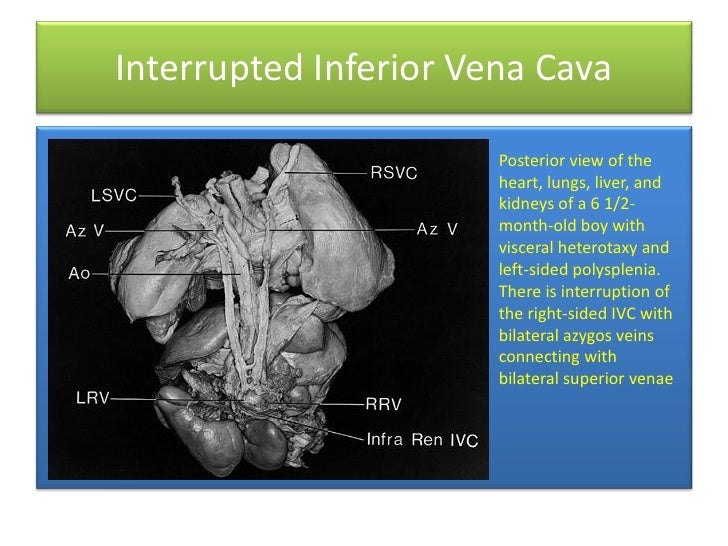 Systemic venous anomalies