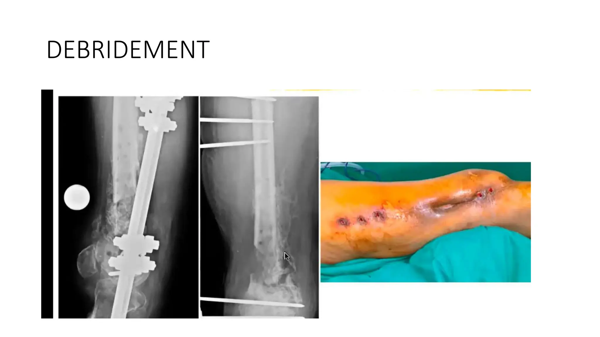 infected_non_union in open fractures and it's approaches | PPTX