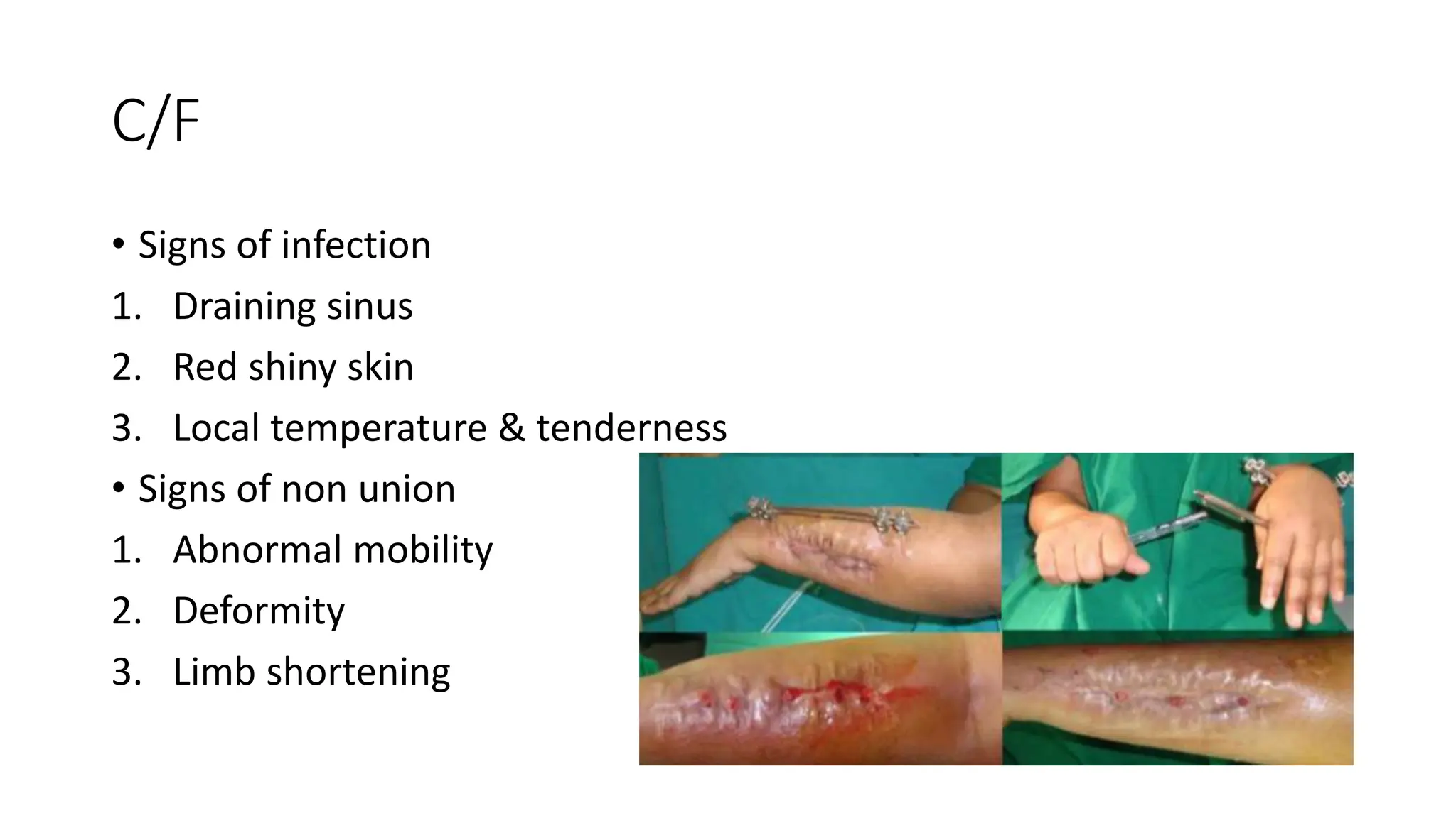 infected_non_union in open fractures and it's approaches | PPTX