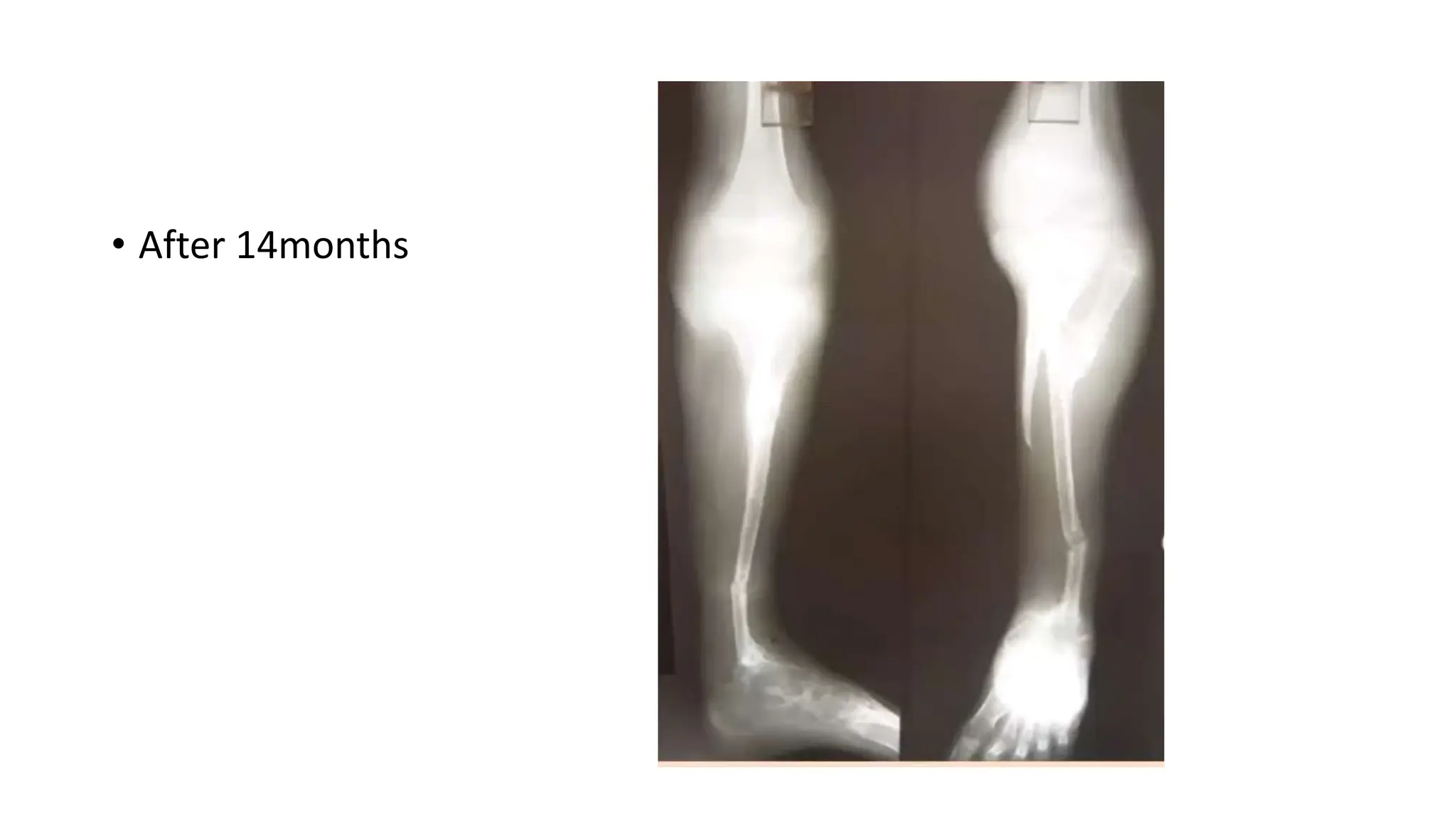 infected_non_union in open fractures and it's approaches | PPTX