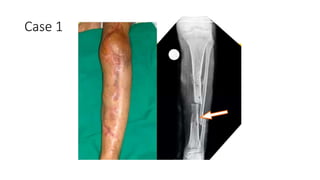 infected_non_union in open fractures and it's approaches | PPTX