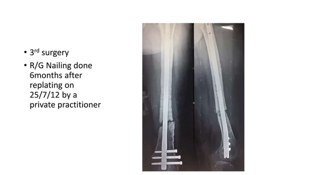 infected_non_union in open fractures and it's approaches | PPTX