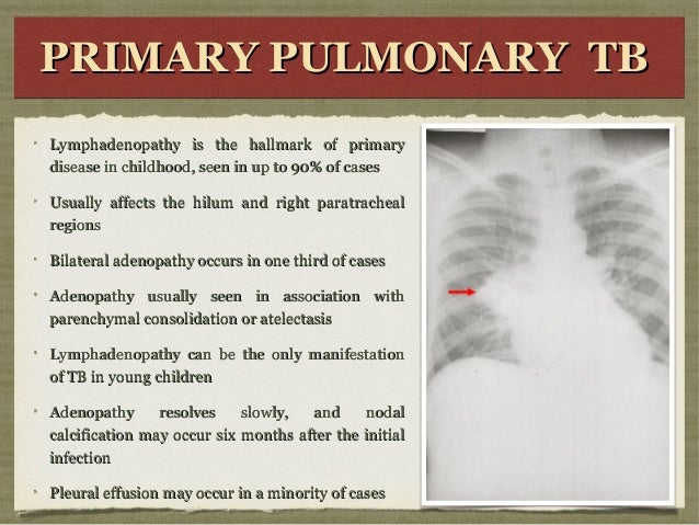 Pulmonary Tuberculosis