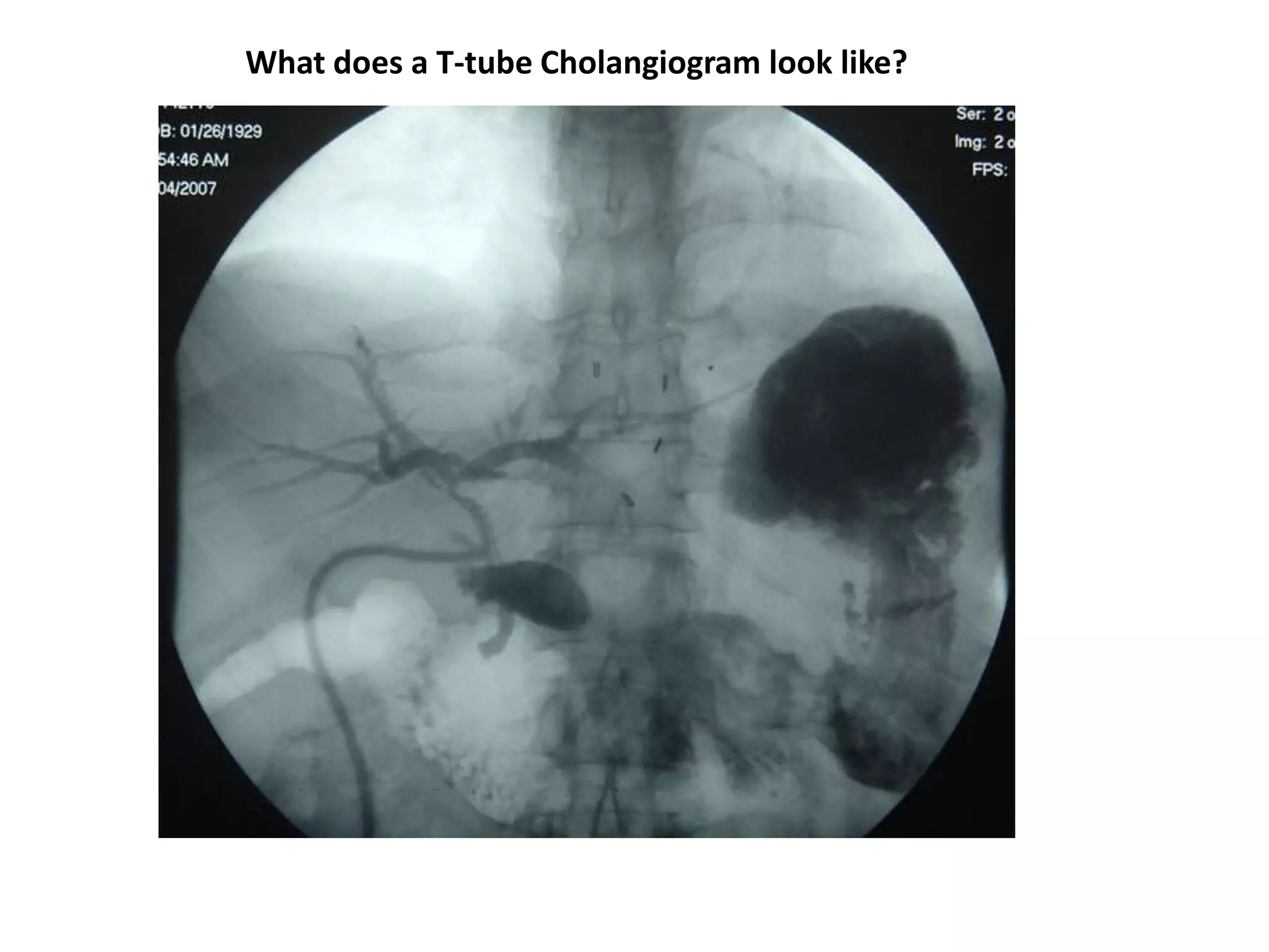 T-tube Cholangiogram | PPSX