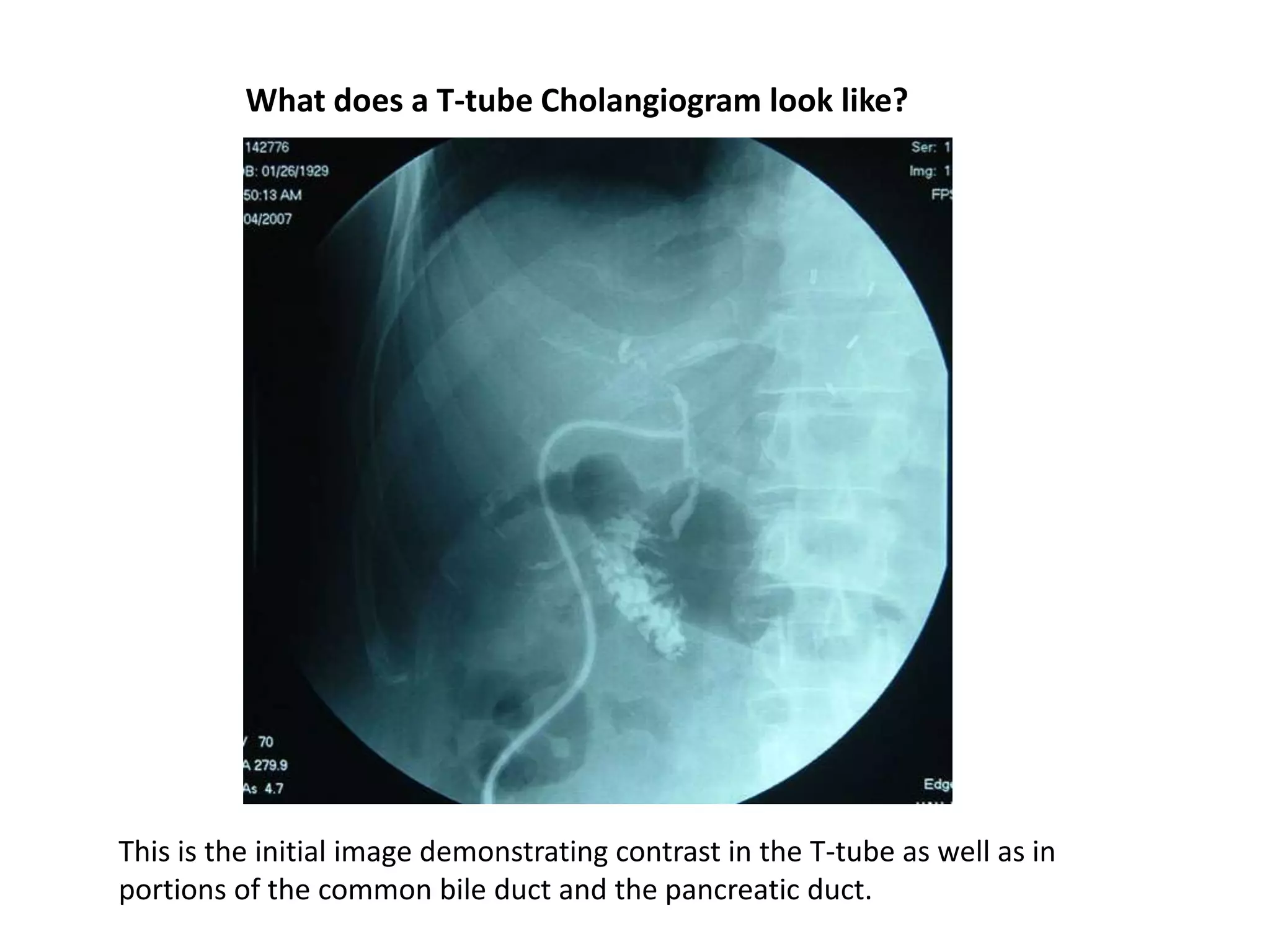 T-tube Cholangiogram | PPSX