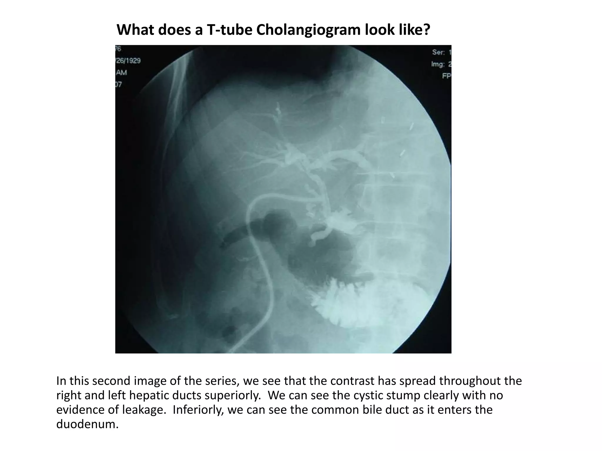 T-tube Cholangiogram | PPSX