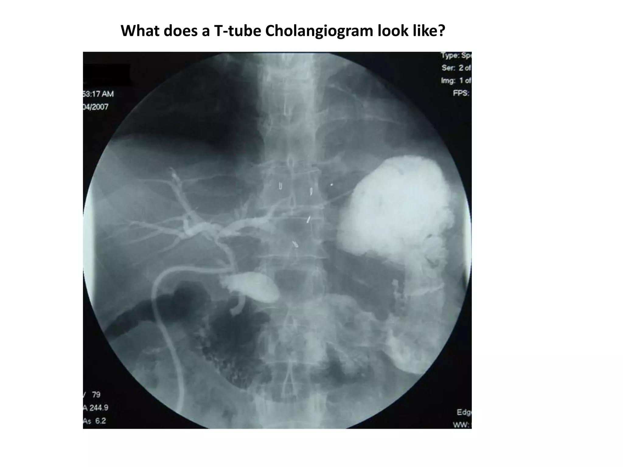 T-tube Cholangiogram | PPSX