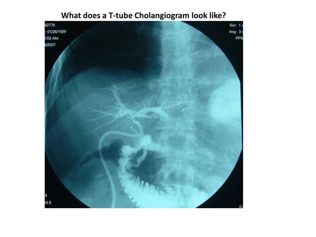 T-tube Cholangiogram | PPSX