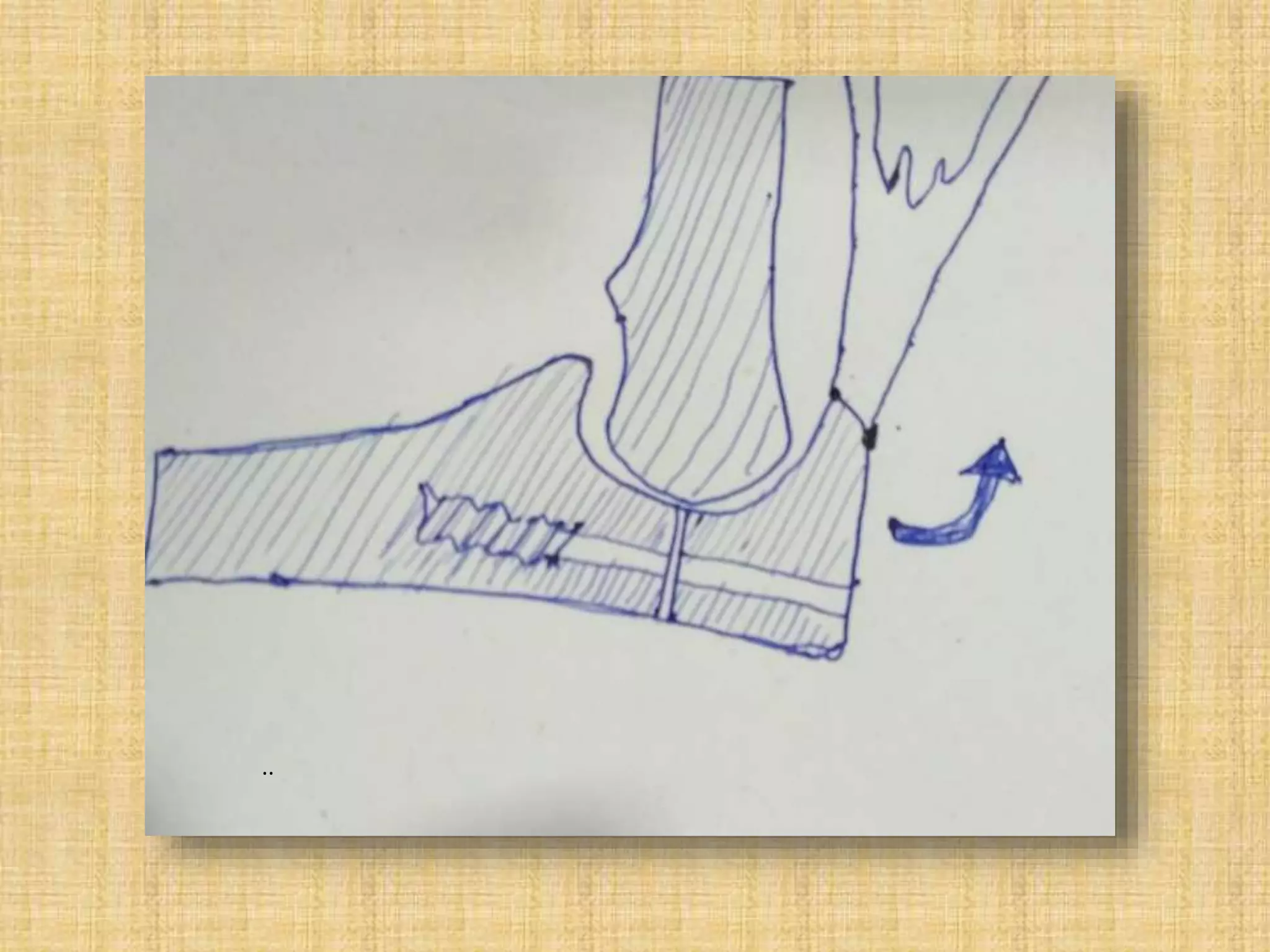 T y elbow treatment by cross k wire technique | PPT