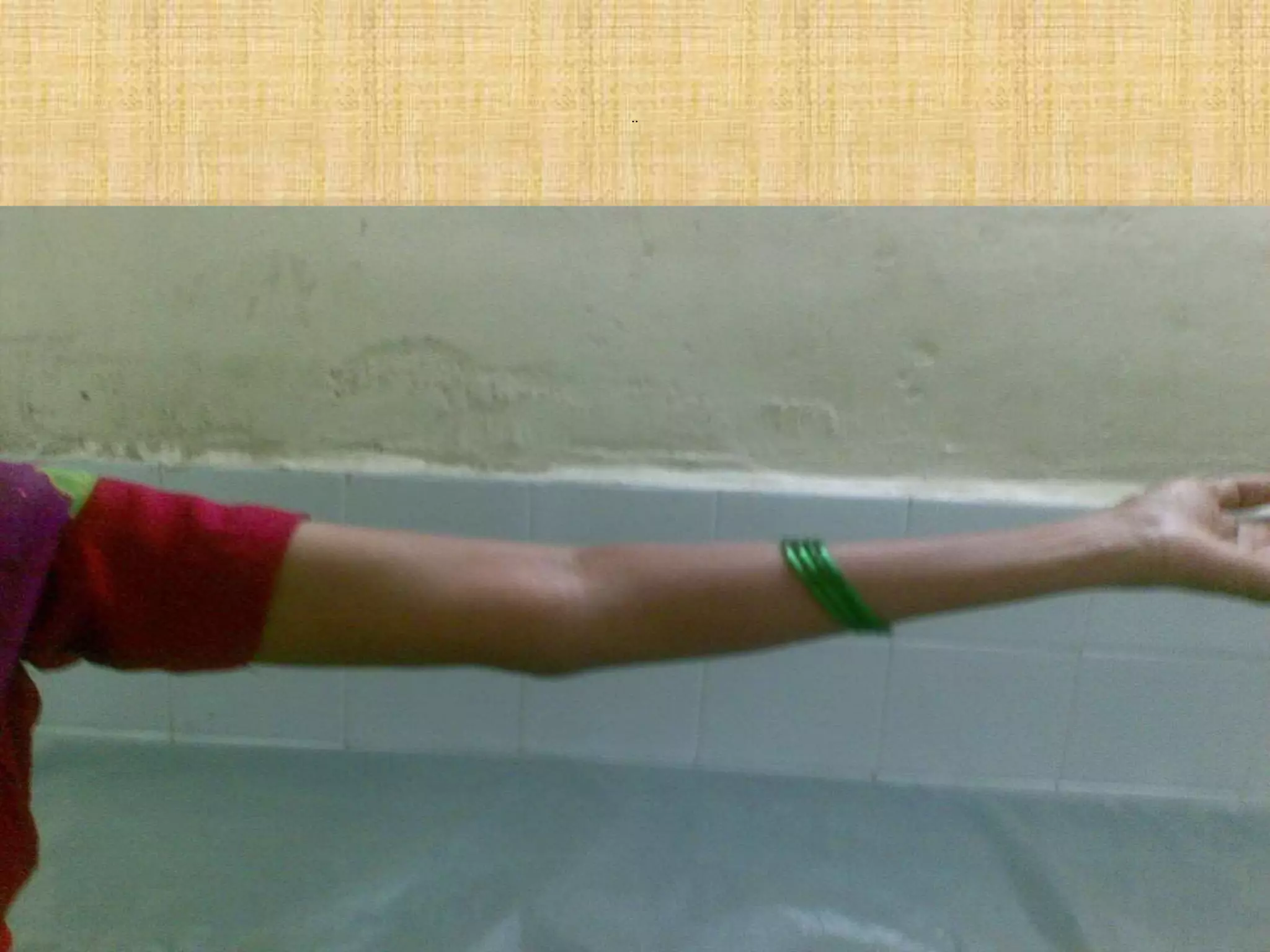T y elbow treatment by cross k wire technique | PPT