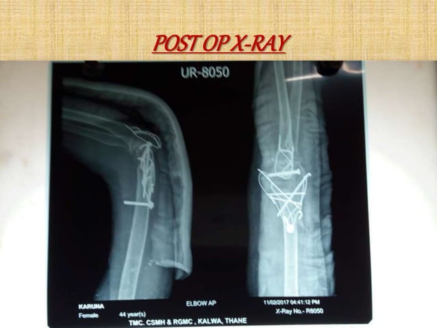 T y elbow treatment by cross k wire technique | PPT