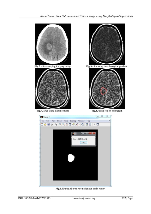 Brain Tumor Area Calculation in CT-scan image using Morphological Operations | PDF