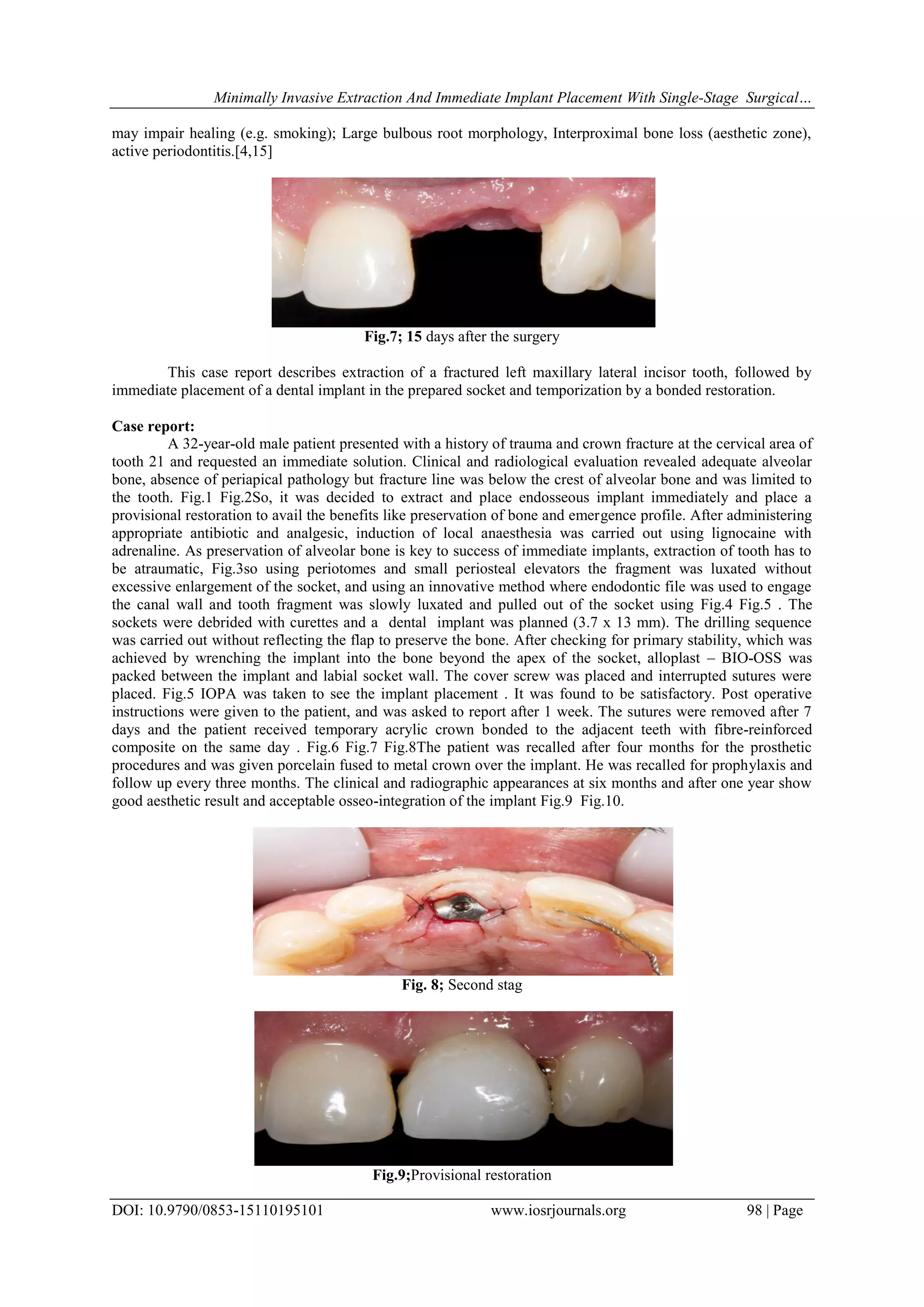 Minimally Invasive Extraction and Immediate Implant Placement with Single-Stage Surgical ...