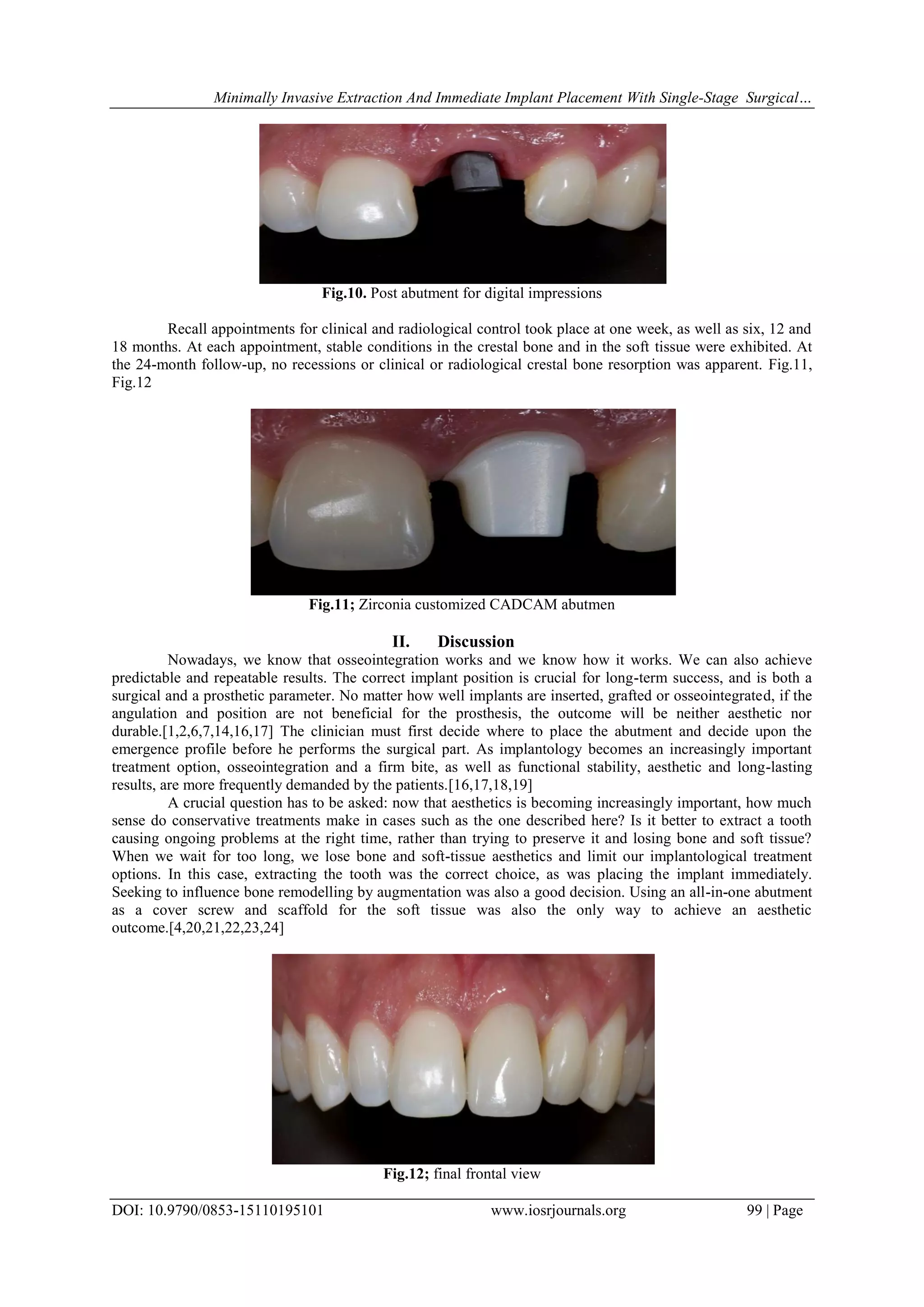 Minimally Invasive Extraction and Immediate Implant Placement with Single-Stage Surgical ...