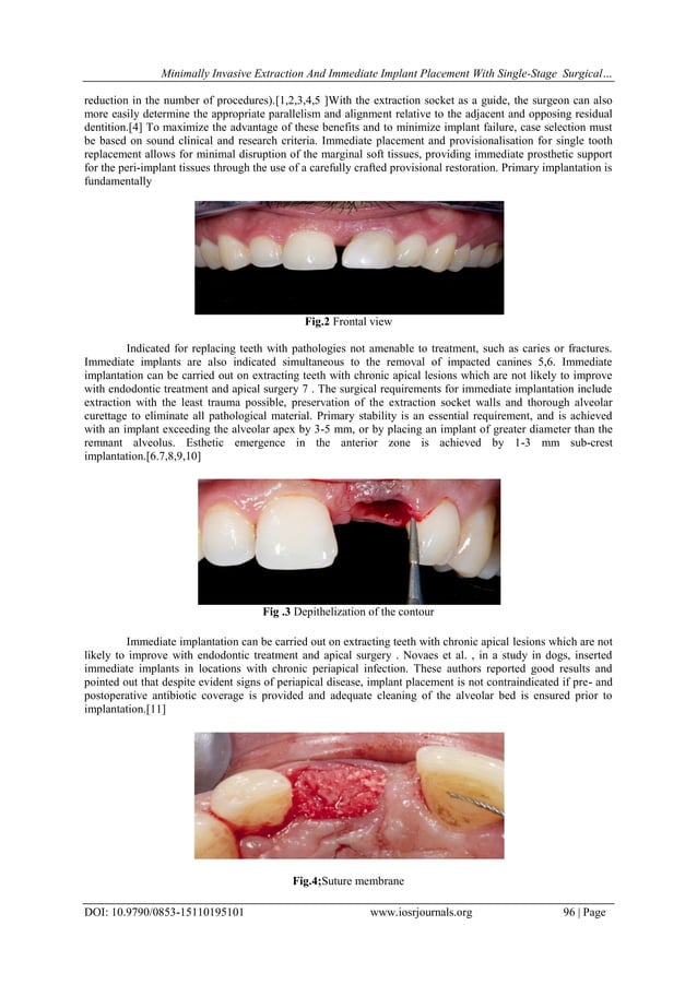 Minimally Invasive Extraction and Immediate Implant Placement with Single-Stage Surgical ...