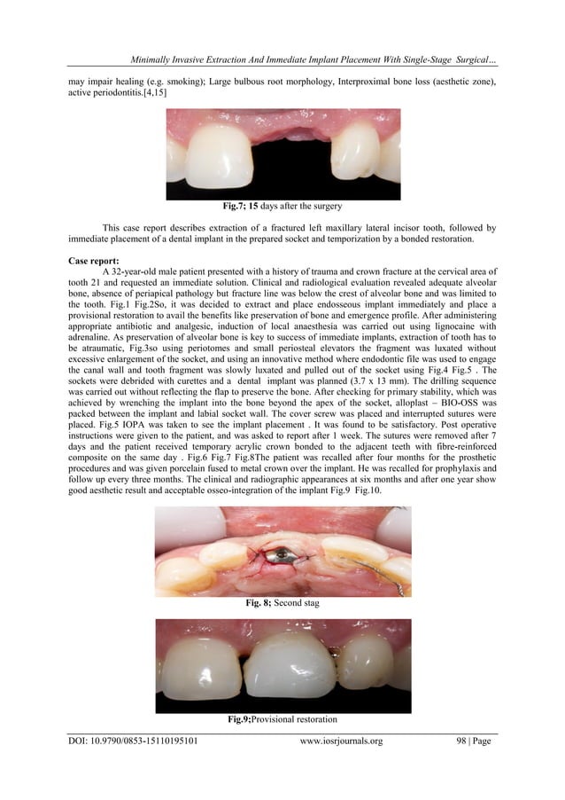 Minimally Invasive Extraction and Immediate Implant Placement with Single-Stage Surgical ...