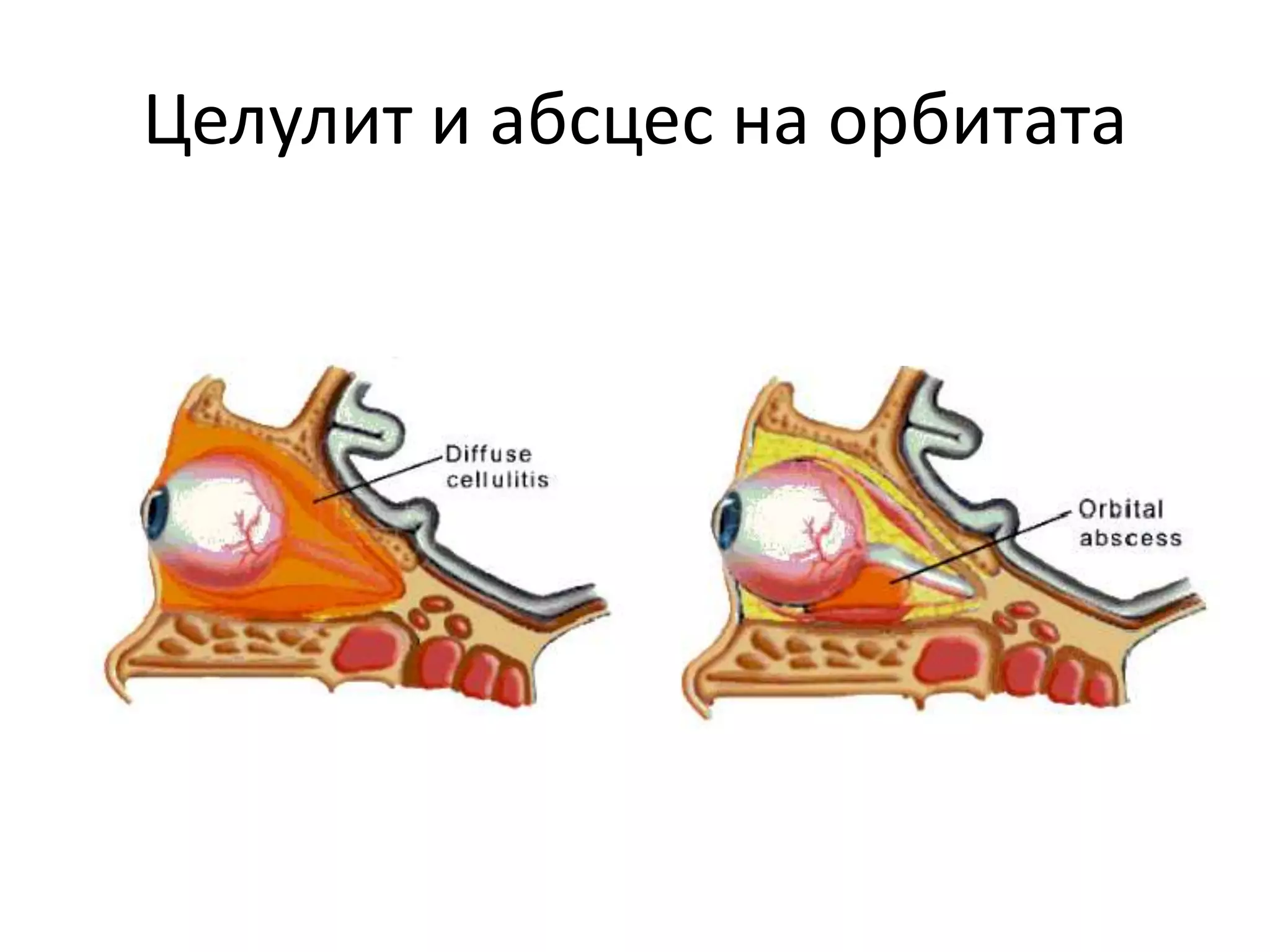 T1 abscessi and phlegmone of the face trif | PPT