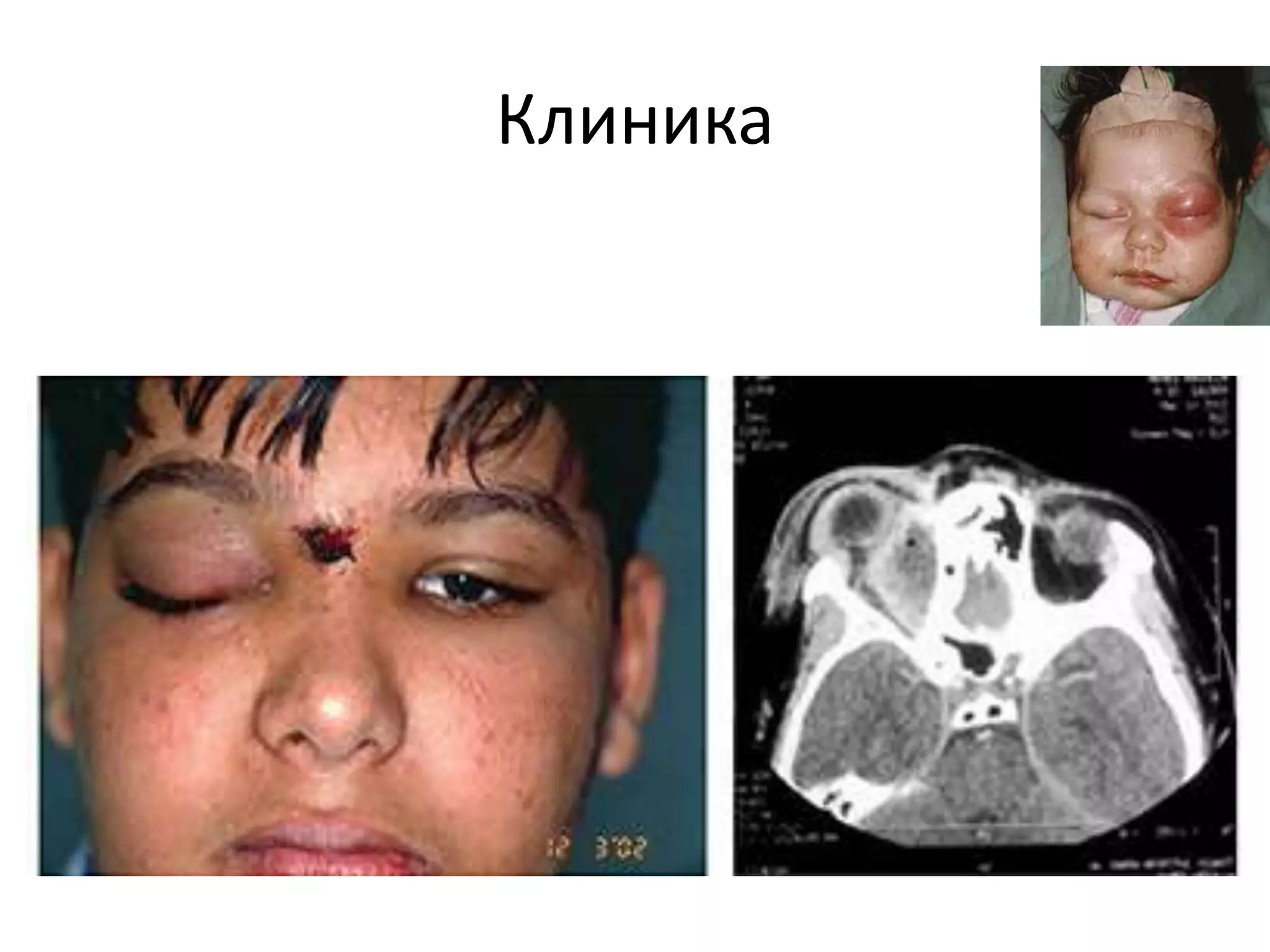 T1 abscessi and phlegmone of the face trif | PPT