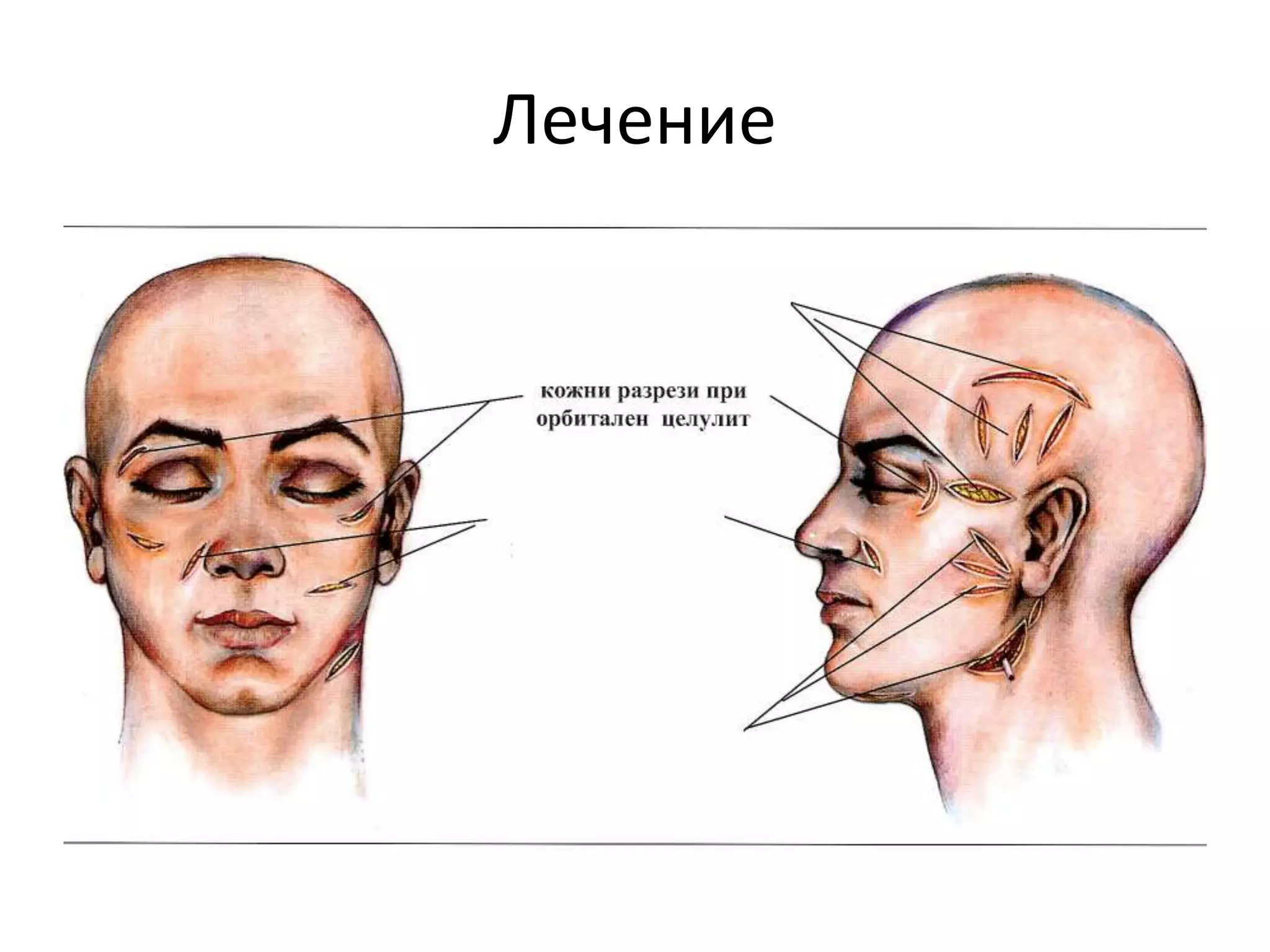 T1 abscessi and phlegmone of the face trif | PPT