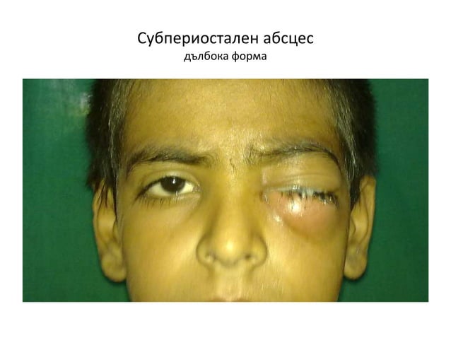 T1 abscessi and phlegmone of the face trif | PPT