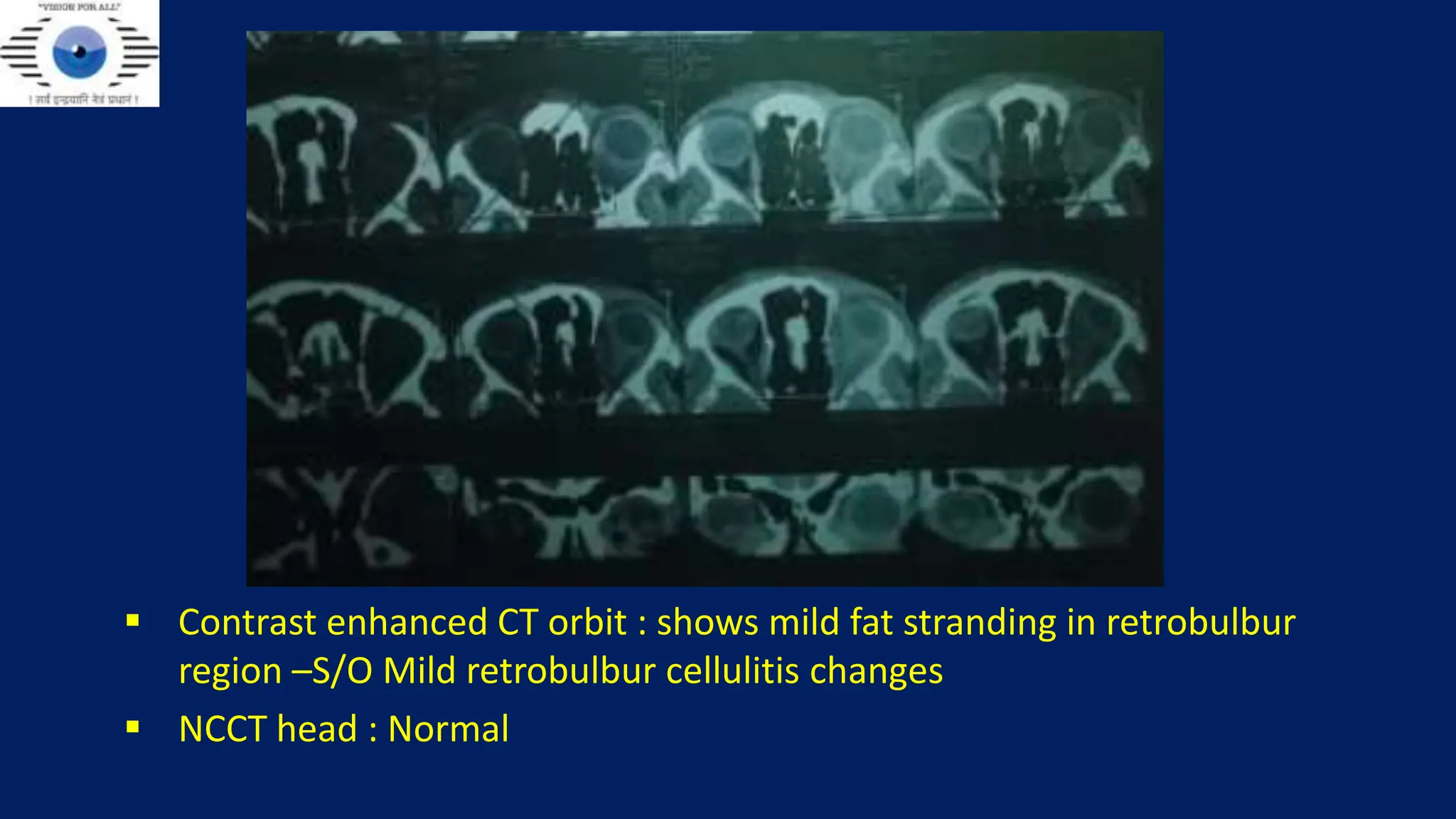 orbital_pseudotumor presentation dhir hospital bhiwani.pptx