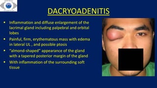 orbital_pseudotumor presentation dhir hospital bhiwani.pptx