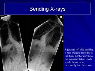 Case Review #12: 14 Year Old Female with Adolescent Idiopathic ...