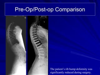 Case Review #12: 14 Year Old Female with Adolescent Idiopathic ...