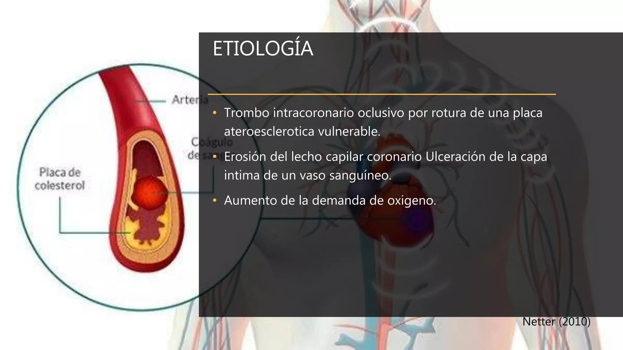 Infarto agudo al miocardio | PPTX