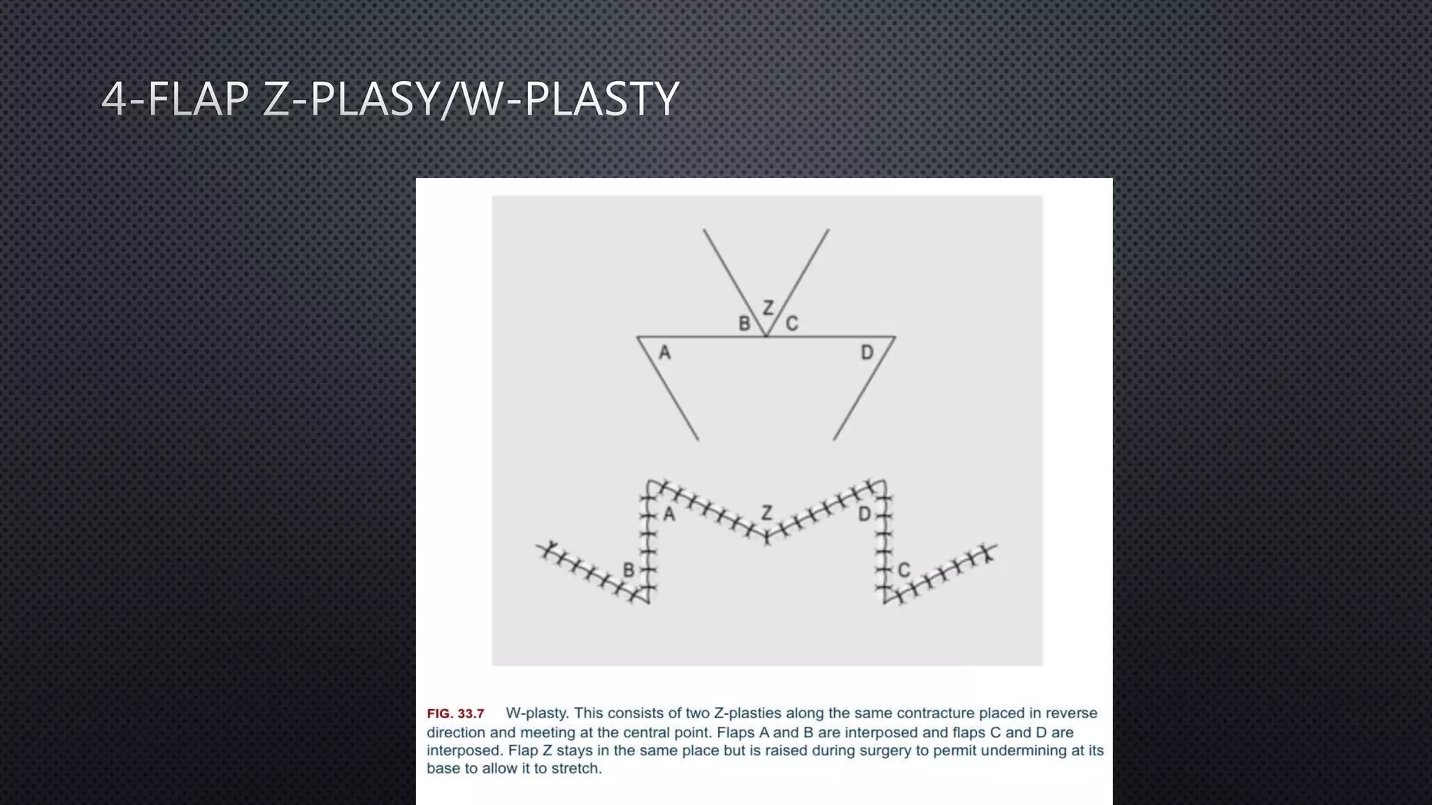 Facial flaps | PPT