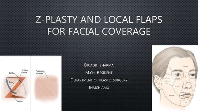 Facial flaps | PPT