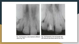 Permenant tooth trauma | PPTX