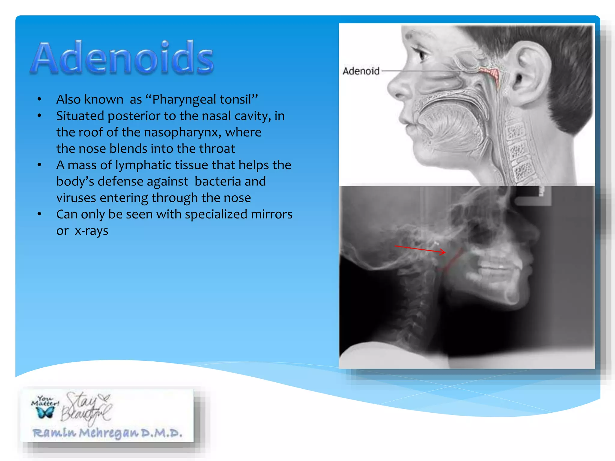 Tonsils & Adenoids and their effect on growth | PPTX