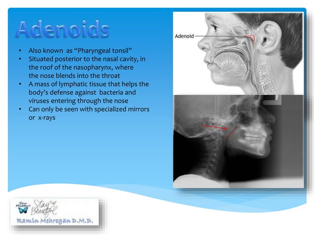 Tonsils & Adenoids and their effect on growth | PPTX