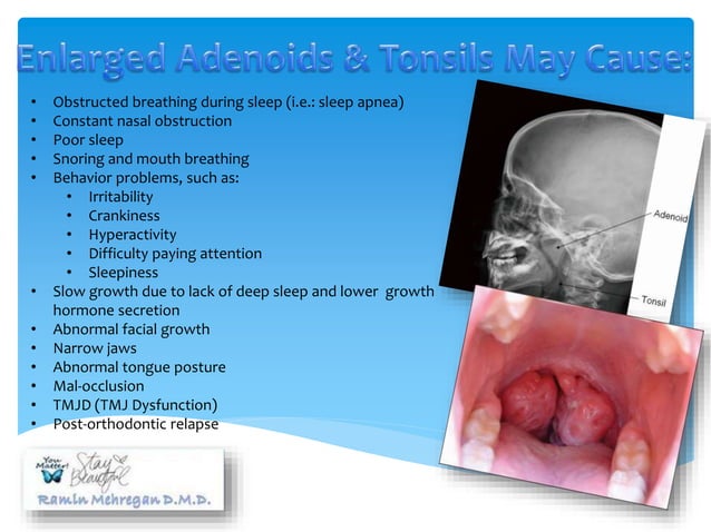 Tonsils & Adenoids and their effect on growth | PPT