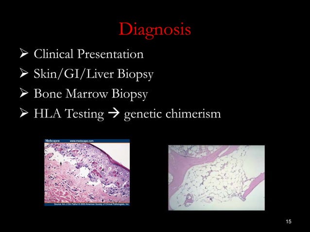 Ta gvhd | PPT | Blood Disorders | Diseases and Conditions