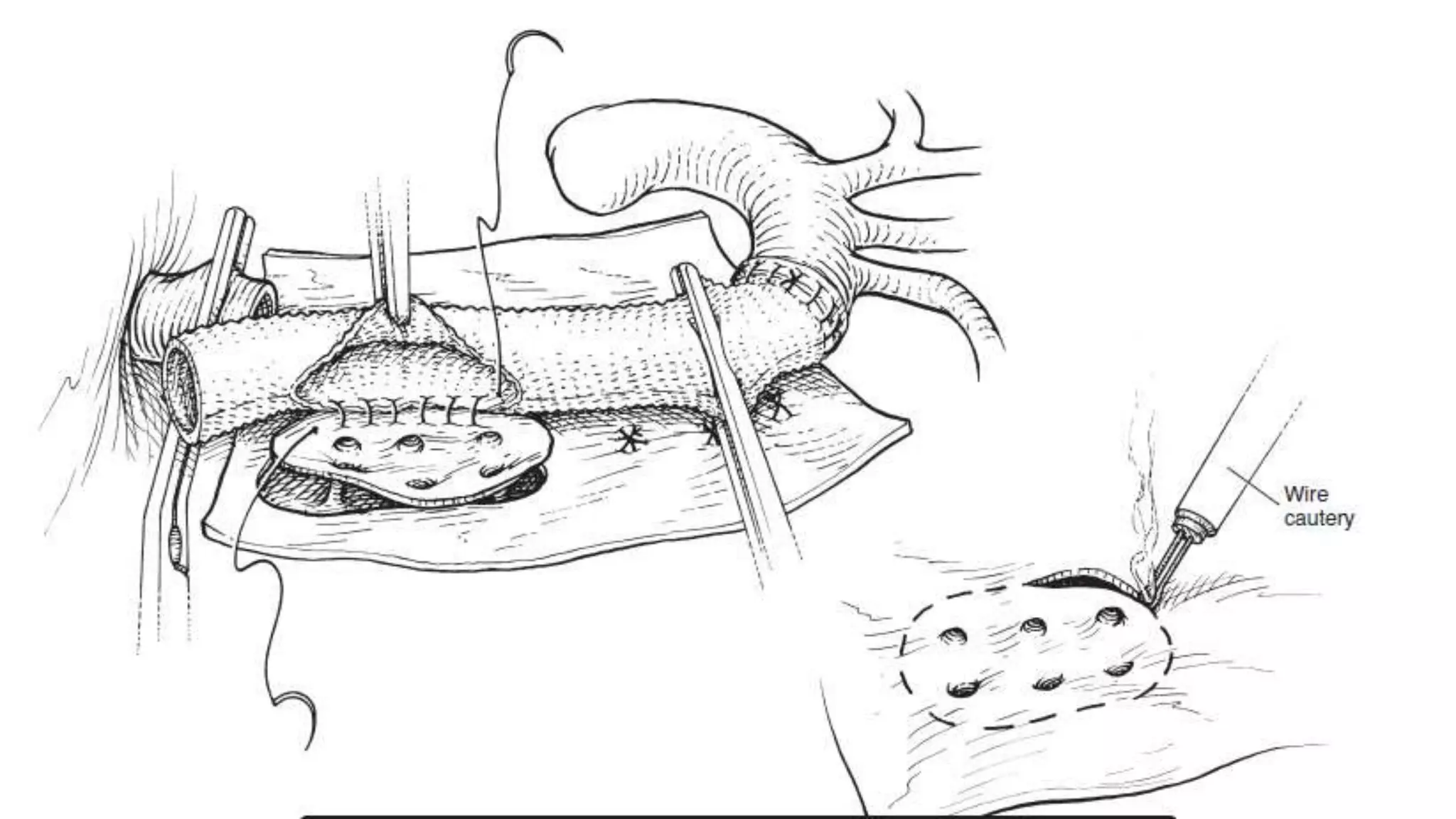 Thoraco abdominal aortic aneurysm(TAAA) management | PPTX | Death ...
