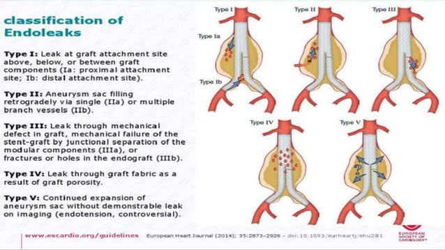 Thoraco abdominal aortic aneurysm(TAAA) management | PPTX | Death ...