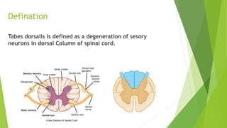 Tabes Dorsalis Spinal Cord