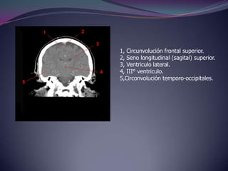 Imagenología(TAC) Cerebro | PPTX