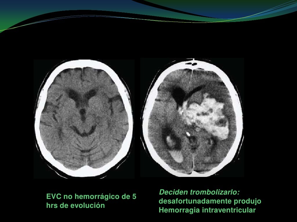 TAC CRÁNEO: interpretación hallazgos patológicos