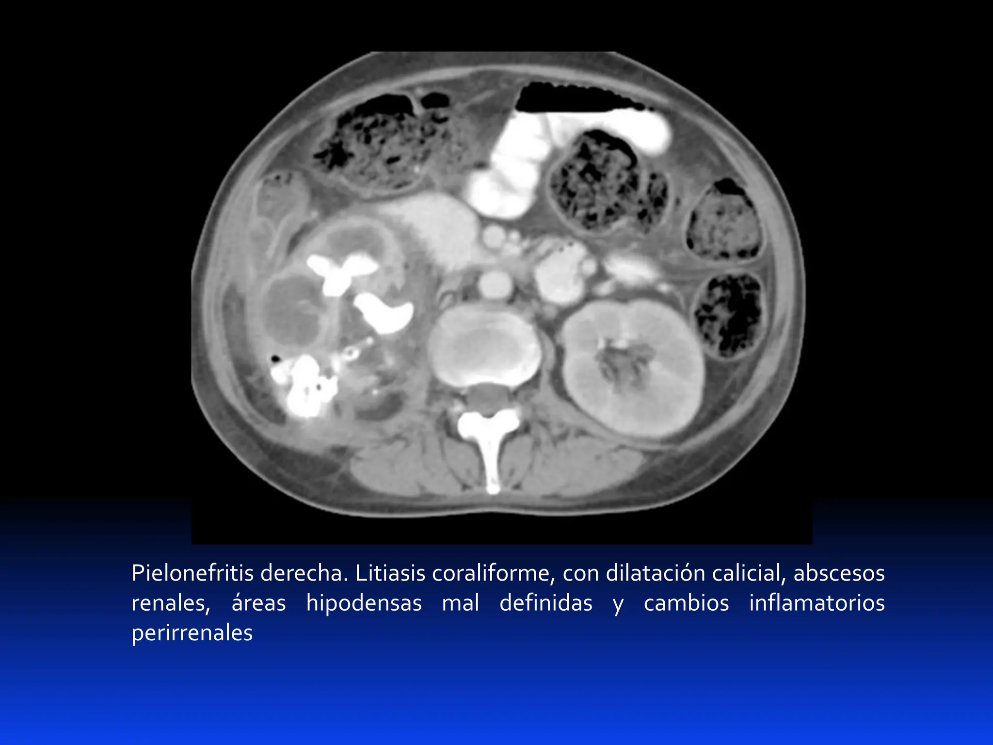 TAC de Abdomen y pelvis.pdf | Medical Health