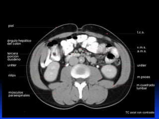 TAC de Abdomen y pelvis.pdf