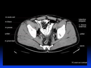 TAC de Abdomen y pelvis.pdf